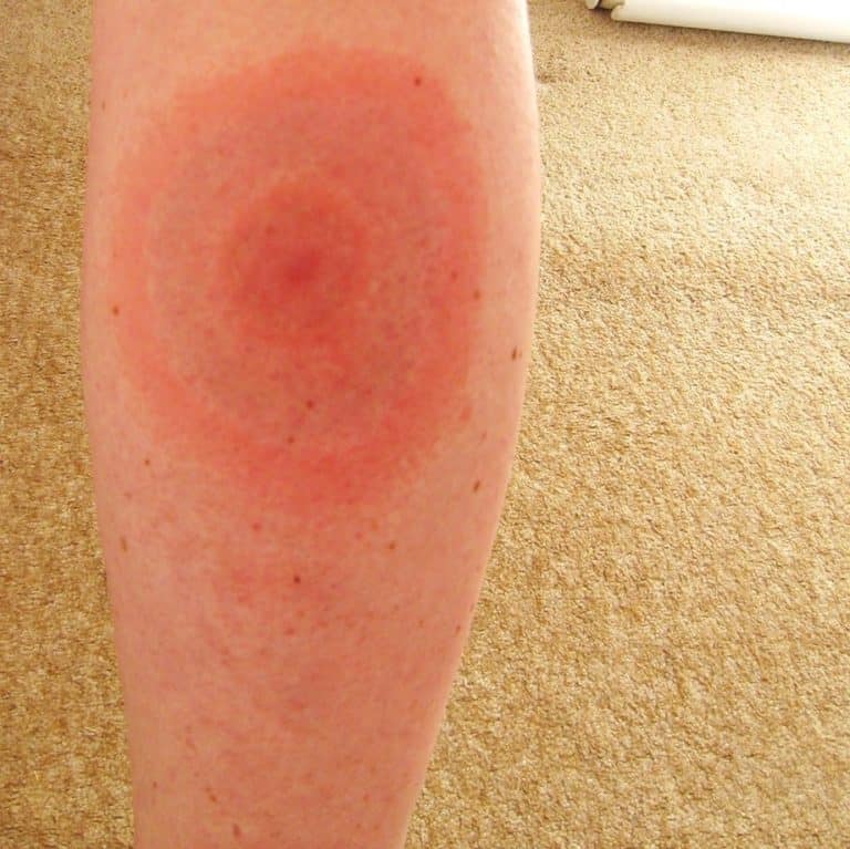 Recording Ticks in the UK (Guest Blog from the Tick Surveillance Scheme ...